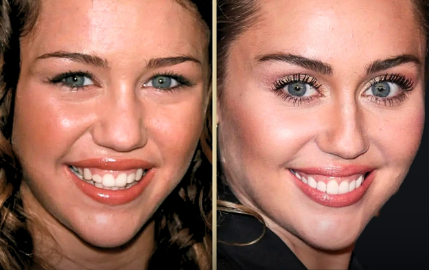 Celebrity Dental Implants and Veneers Before and After