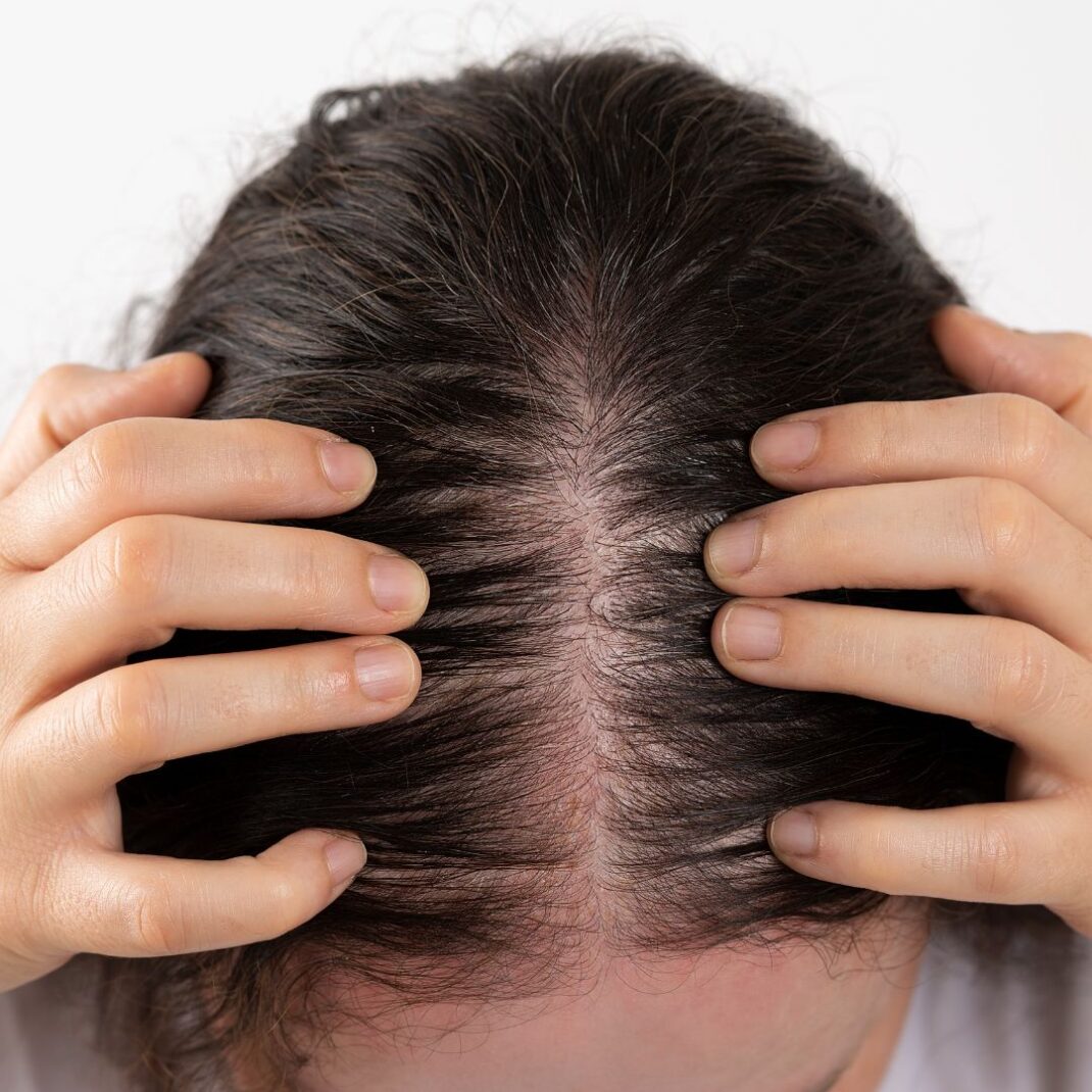 PCOS Hair Loss: Causes, Treatments, Home Remedies, and Support