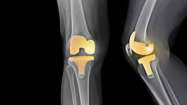 Knee Surgery: A Comprehensive Guide - Erdem Hospital