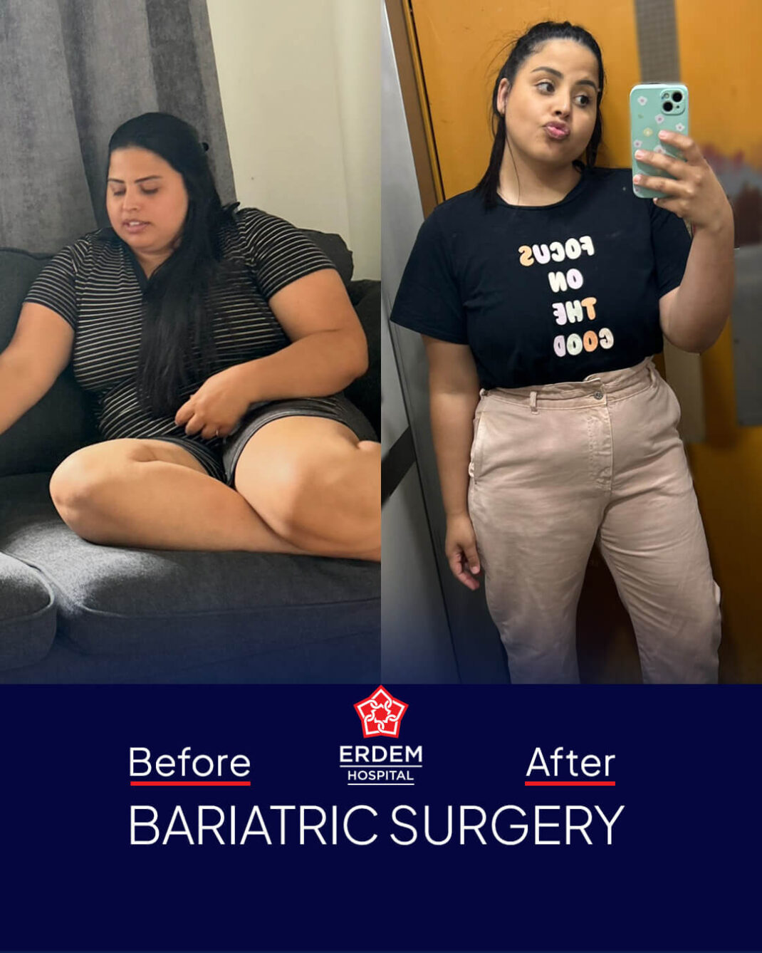 Gastric Sleeve in Turkey | Erdem Hospital