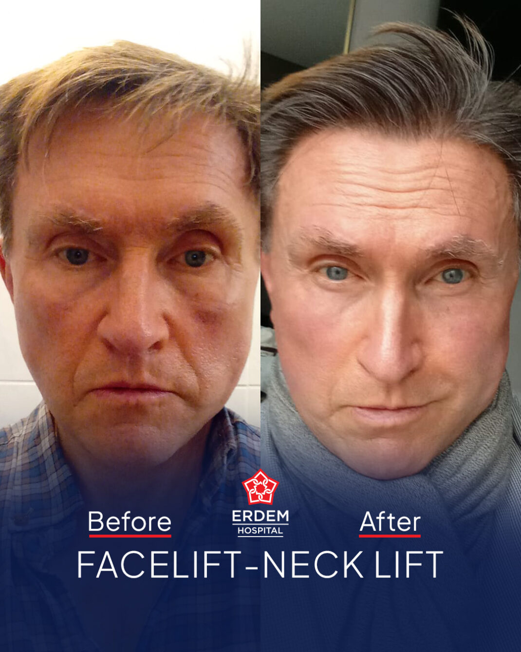 Neck Lift Surgery in Turkey - Erdem Hospital
