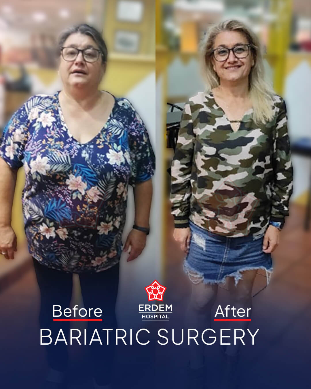 Gastric Sleeve in Turkey | Erdem Hospital