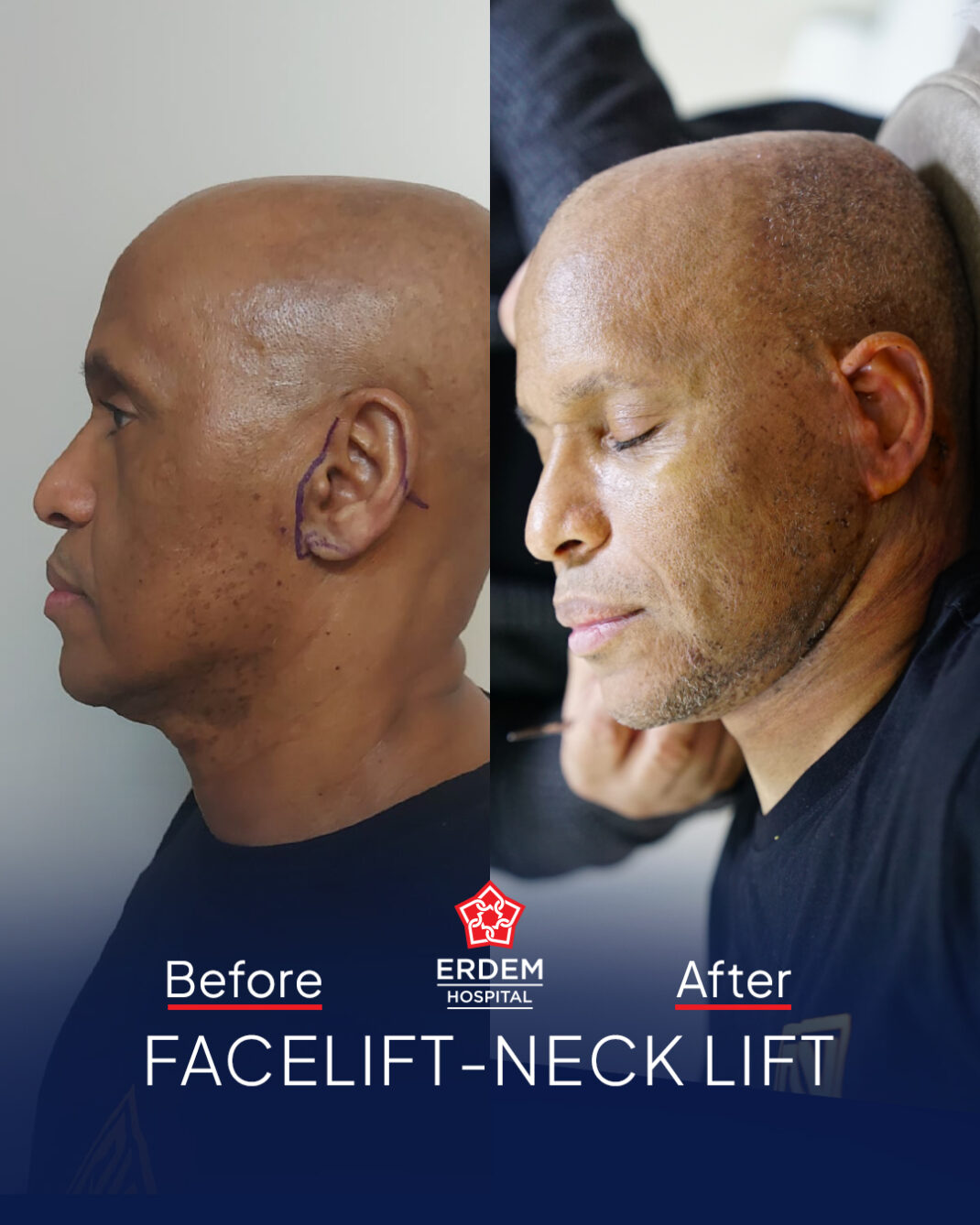 Neck Lift Surgery in Turkey - Erdem Hospital