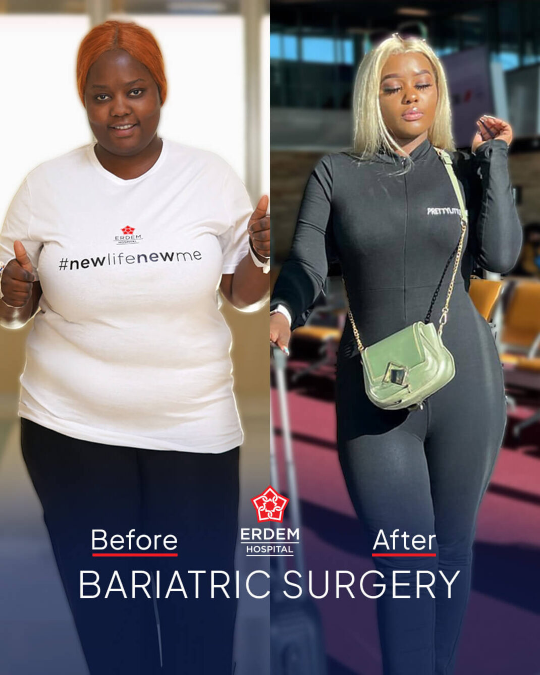 Gastric Sleeve in Turkey | Erdem Hospital