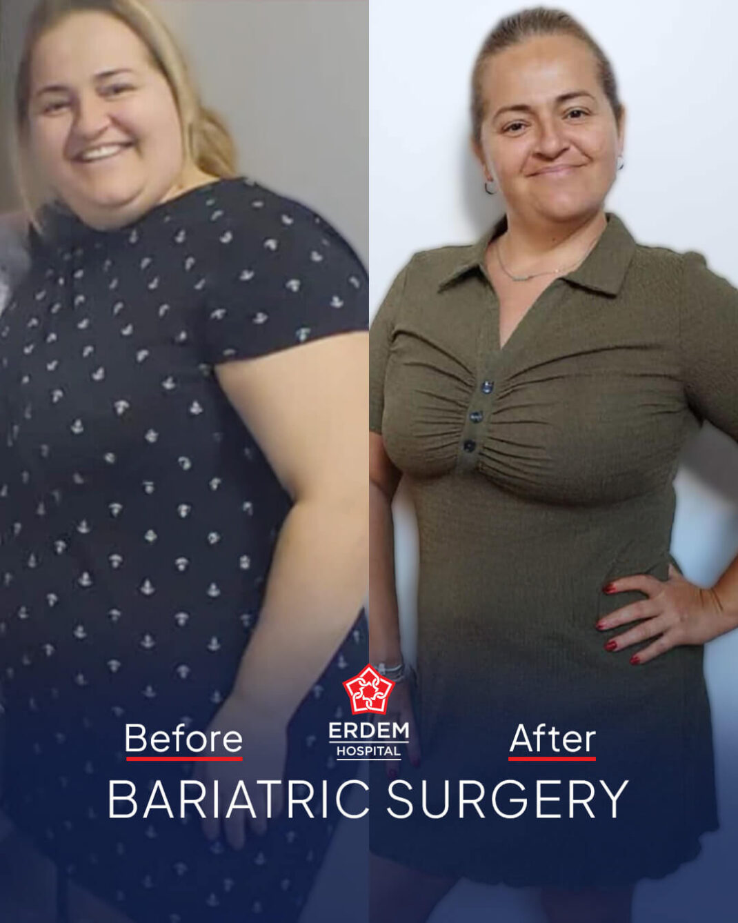 Gastric Sleeve in Turkey | Erdem Hospital