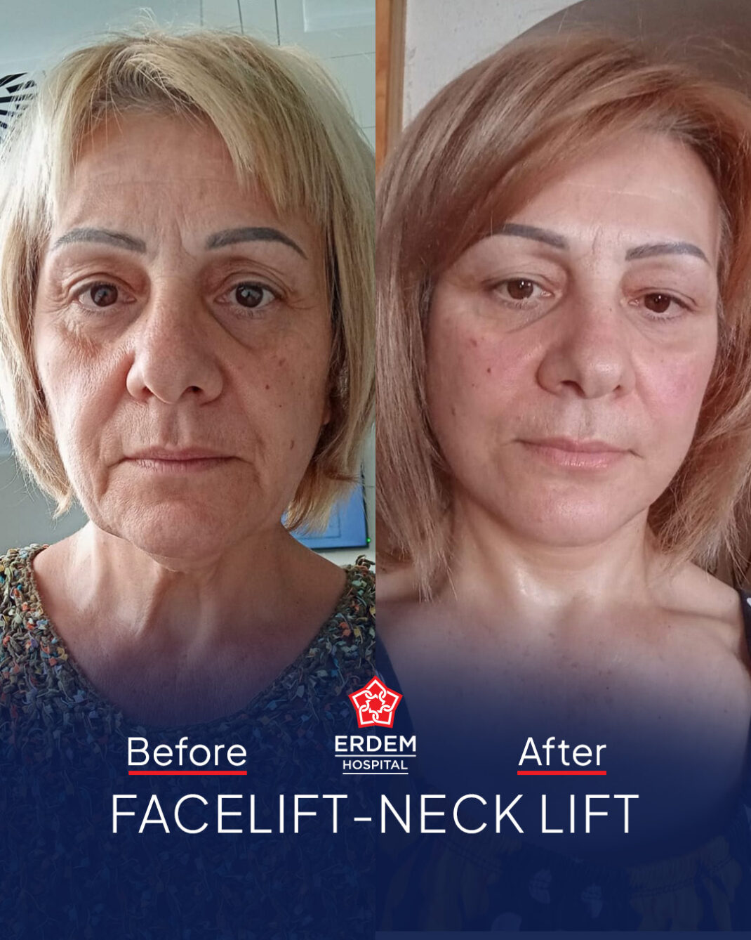 Neck Lift Surgery in Turkey - Erdem Hospital