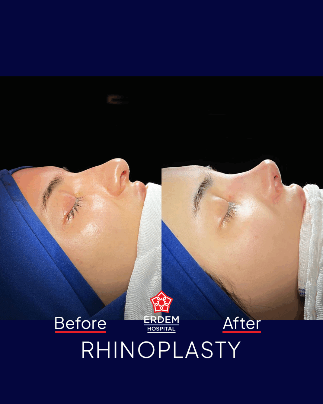 Nadia Bernat’s Journey to Confidence: A Rhinoplasty Story
